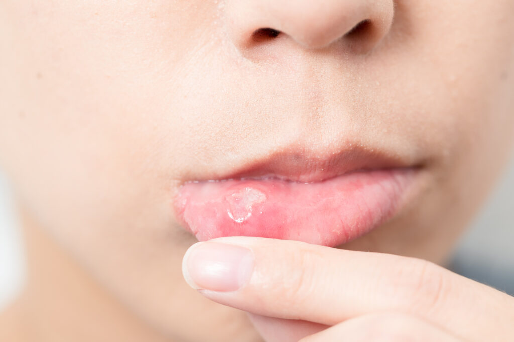 Woman suffer from mouth aphtha | MYメディカルクリニック